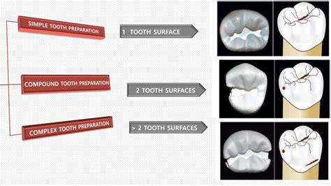 Fundamentals Of Cavity Preparation Pptx Dental Health Diseases