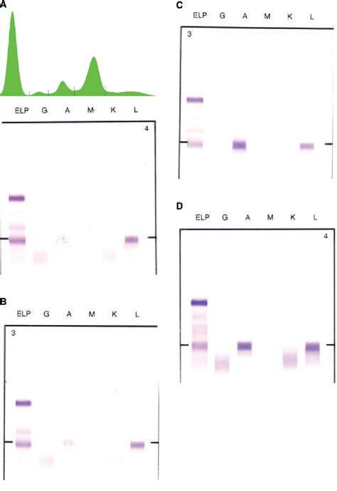 Figure 1 From Prozone Effect Observed For Heavy Chain α In The Serum