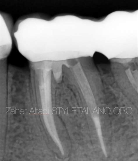 Perforation Repair Step By Step Style Italiano Endodontics