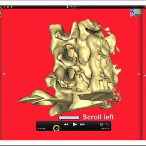 Three Dimensional Surface Reconstruction 3dsr Of A C5 C7 Vertebral