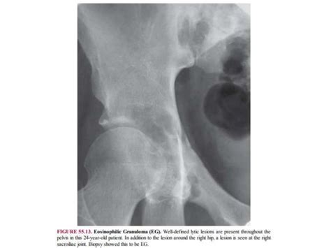 Lytic Lesions Of Bone Ppt