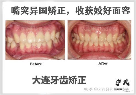 大连牙齿矫正丨为改善嘴突，选择跨国整牙靠谱吗？ 知乎