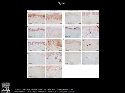 combined use of laser capture microdissection and cdna microarray