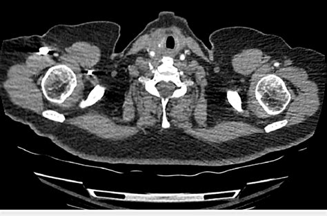 Ct Neck With Contrast Scan Performed Post Total Thyroidectomy And Three Download Scientific