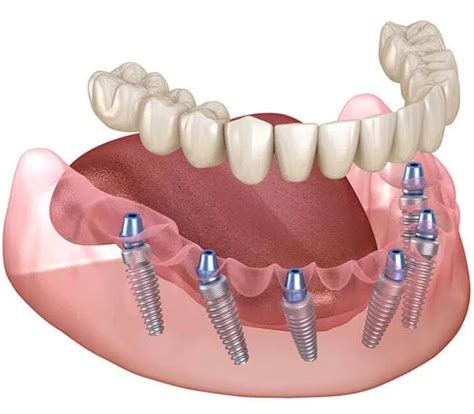 Maxilar Si Mandibula Restaurarea Danturii Cu Implanturi Si Proteze Fixe