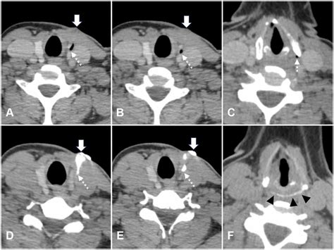 Persistent Cervical Sinus