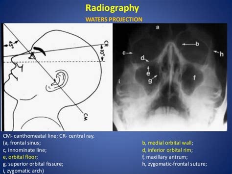 Orbit Imaging Anatomy