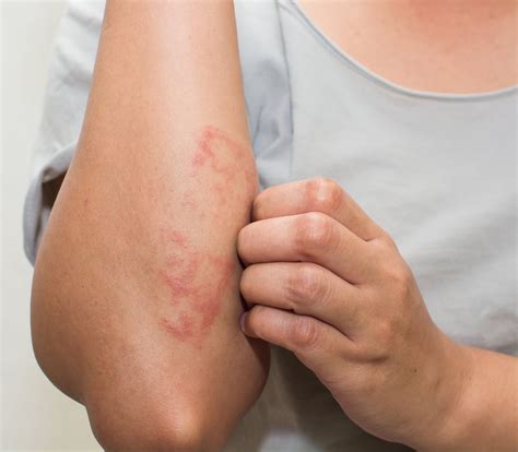 Eczema Treatment In Wilmington Wilmington Dermatology Center