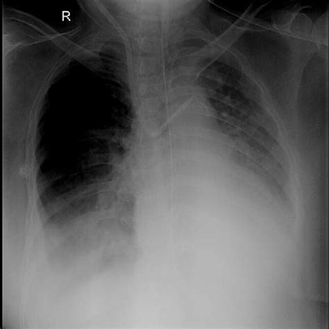 The Right Ijv Dialysis Catheter Traversing Into The Right Subclavian