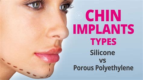 Chin Implants Types Silicone Vs Porous Polyethylene Youtube
