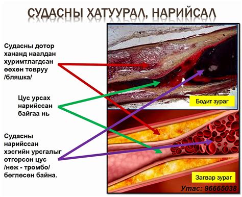 Судасны хатуурал нарийслыг эрүүлжүүлэх нь Тархи Зүрх судасны