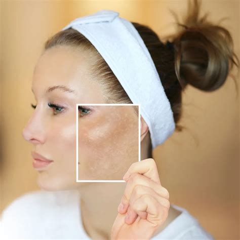 Hyperpigmentation Vs Melasma Treatments That Work Beautifi