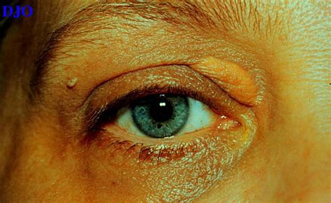 Xanthelasma Cholesterol Deposits Around The Eyes Causes