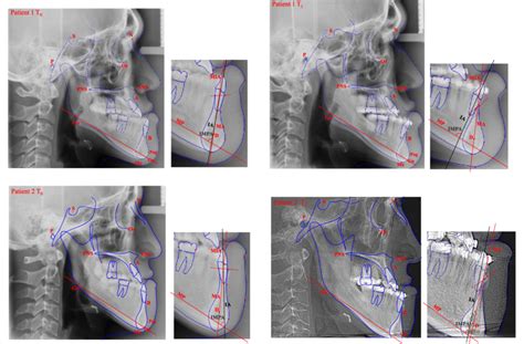 Examples Of Cephalometric Digitization In Severe Skeletal Class Iii Download Scientific Diagram Examples Of Cephalometric Digitization In Severe Skeletal Class Iii Download Scientific Diagram