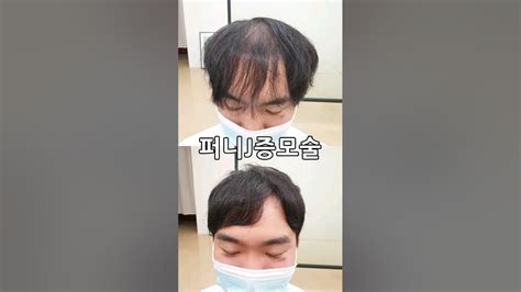 정품 퍼니j 헤어증모술은 탈모인의 헤어스타일까지 생각합니다 Youtube