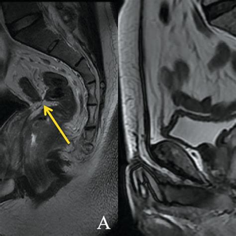 Tumor Location With Regard To The Anterior Peritoneal Reflection Apr