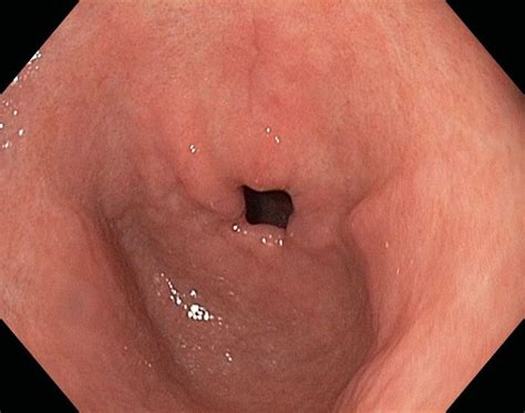 Normal Stomach Endoscopy
