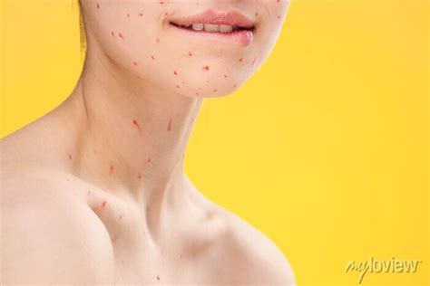 Female Face Closeup Red Dots Dermatology Rash • Wall Stickers Person