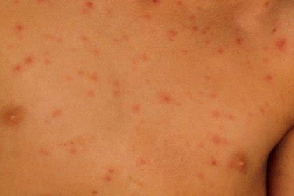 Chickenpox Nhs