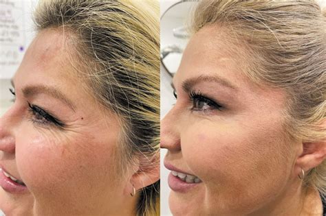 Erase The Years At Synerchi Medical Spa Scripps Ranch News