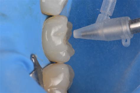 Aquacare Micro Particle Abrasion System