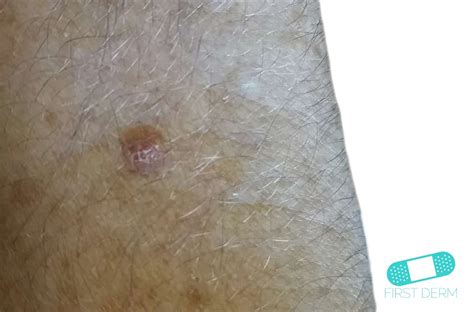 Online Dermatology Actinic Keratosis Ak