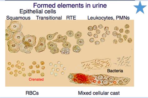 Transitional Renal Epithelial Cells In Urine