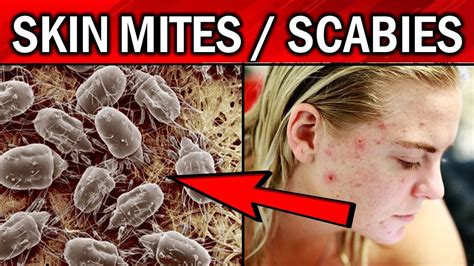 Scabies Mites