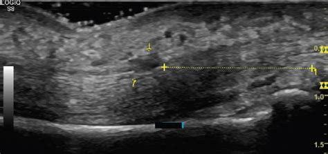 Foreign Bodies Radiology Key