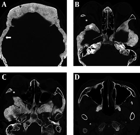 The Maxillary Sinus Download Scientific Diagram