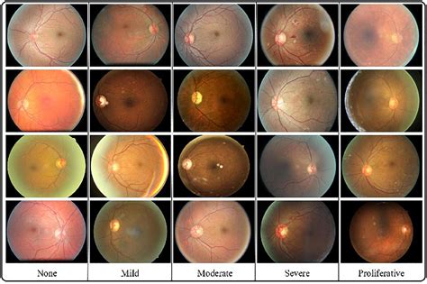 Diabetic Retinopathy Automated Detection