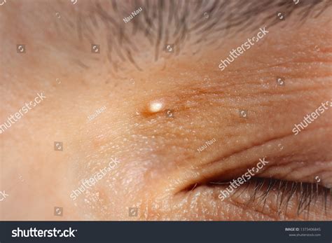 fotos de Quistes milium Fotos imágenes y otros productos fotográficos de stock Shutterstock