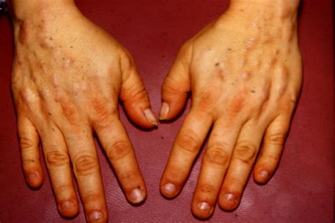 Nodules Nodules Comprehensive Dermatology Photo Atlas Wayne State