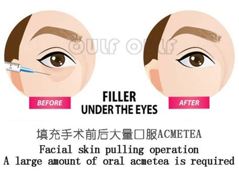 医生碎碎念脂肪填充眼窝能维持多久自体脂肪填充眼窝有害吗 细胞 移植 手术