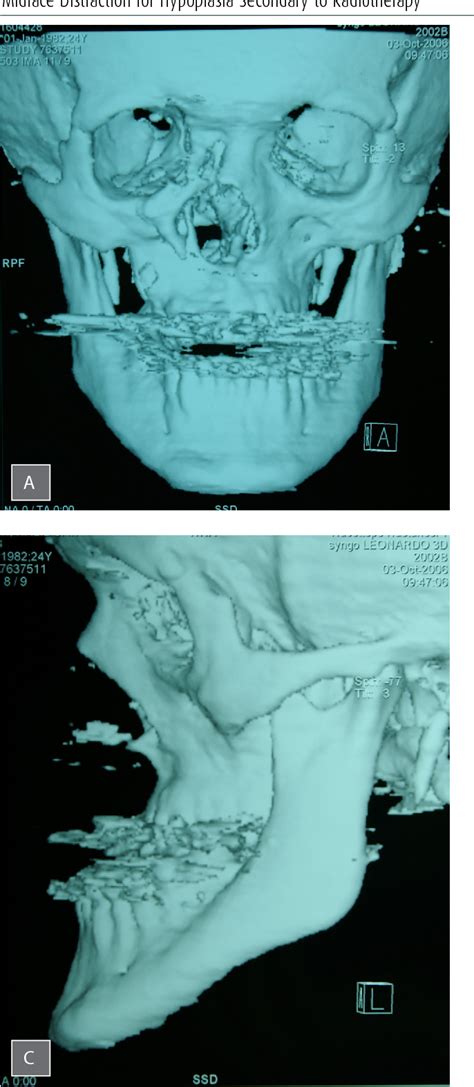 Figure 1 From Le Fort Iii Osteotomy And Distraction For Midface