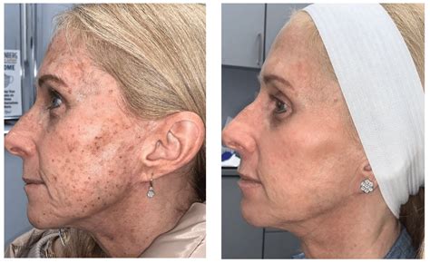 Bbl Photofacial Hero In Chicago At Solve Clinics