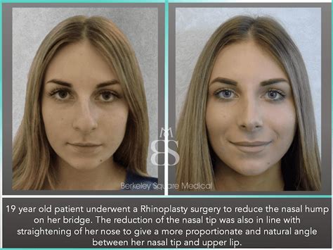 Rhinoplasty Before After London 2 Berkeley Square Medical Central