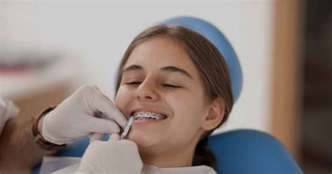 Teal Braces Color Are They Good Fit Ultimate Year Guide
