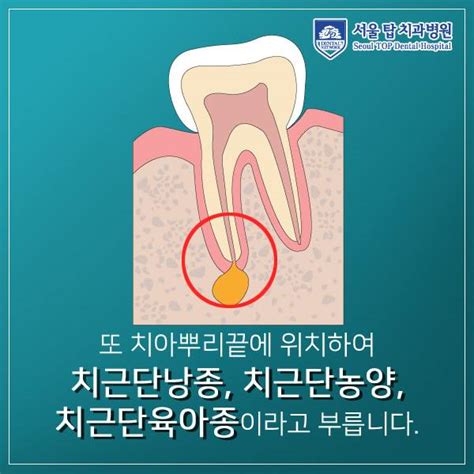 서울탑치과병원 서울탑치과병원 김현종원장의 건치 만들기 치아를 살리는 수술 치근단절제술 Facebook