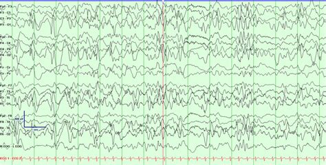 Basics Part I How To Read An Eeg 47 Off