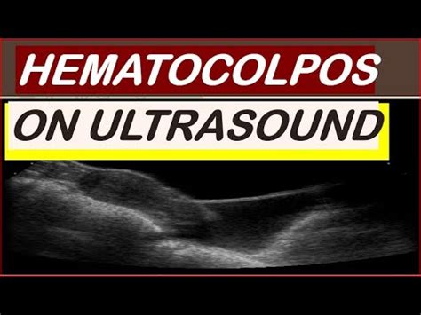 Hematocolpos On Ultrasound Youtube