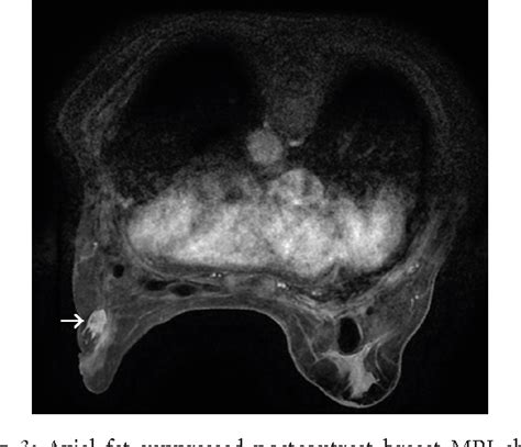 Figure 1 From The CientificWorldJOURNAL Clinical Study Enhanced MRI And