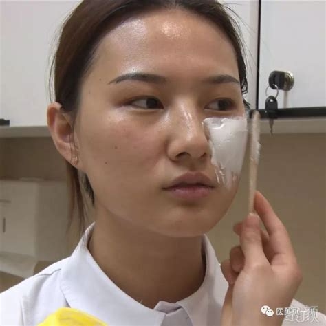 四川晶肤做皮秒祛斑 术后一个多月效果分享 蜜颜优惠