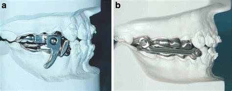 A Functional Mandibular Advancer Fma B Herbst Appliance Download