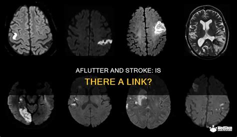 Aflutter And Stroke Is There A Link Medshun
