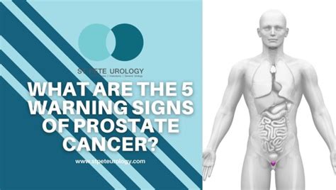 What Are The Warning Signs Of Prostate Cancer St Pete Urology