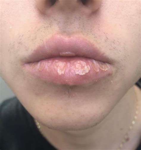 Should I Pick The Scabs Off Or Leave Them Alone R Exfoliativecheilitis