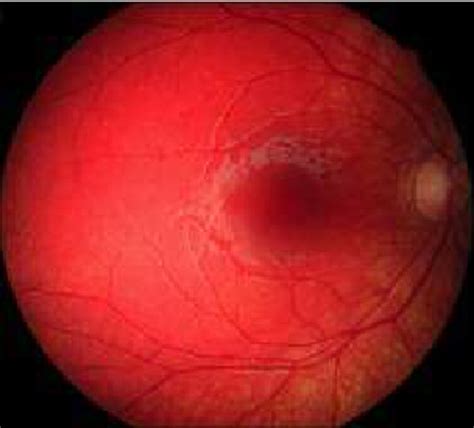 Fundus Of The Right Eye A Shows Hypopigmentation While The Left Eye