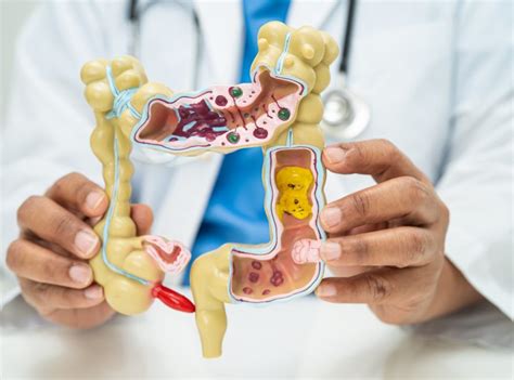 Bowel Cancer Causes Symptoms Tests And Treatment Options