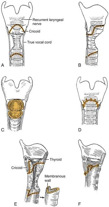 Glottic And Subglottic Stenosis Ento Key